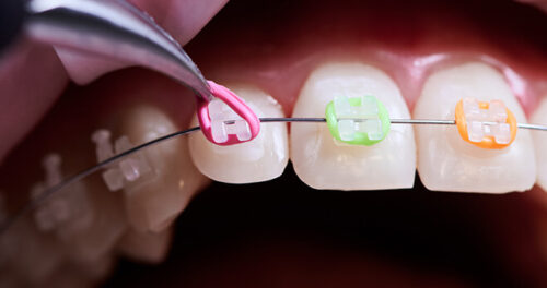 Let's talk about bite blocks... what are they? - Dental Negligence